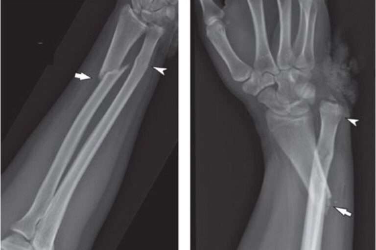 Fracture Treatment - Dr. Sayyad's Orthopaedic Clinic